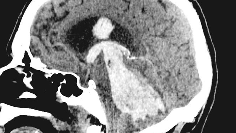 Ghost In The Brain: An 'Apparition Hemorrhage' : Shots - Health News : NPR