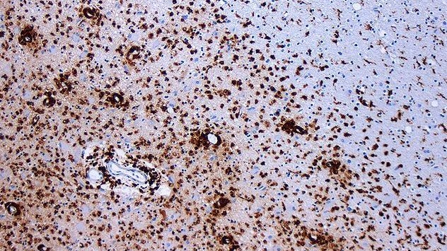 Novartis Pill For Multiple Sclerosis Wins Approval, But At What Cost ...