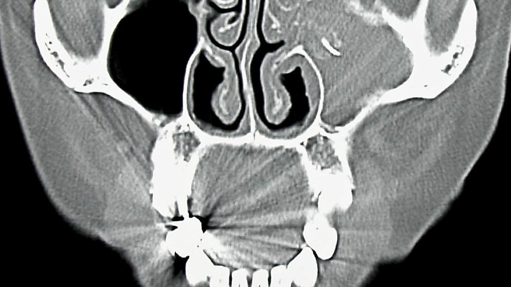 Surgery For Sinus Misery: Better, But Still No Cure : NPR