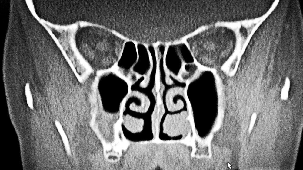 Surgery For Sinus Misery: Better, But Still No Cure : NPR