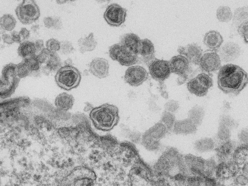 Doubts Rise Over Virus As Cause Of Chronic Fatigue Syndrome : Shots ...