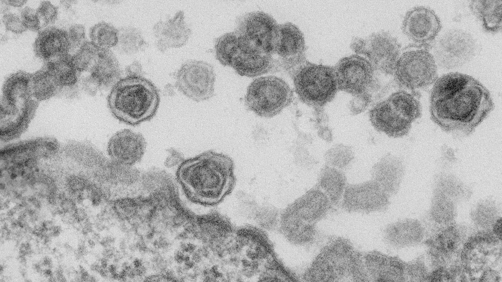 Doubts Rise Over Virus As Cause Of Chronic Fatigue Syndrome : Shots ...