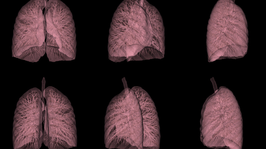 Experts Question Bargain CT Scans For Smokers : Shots - Health News : NPR