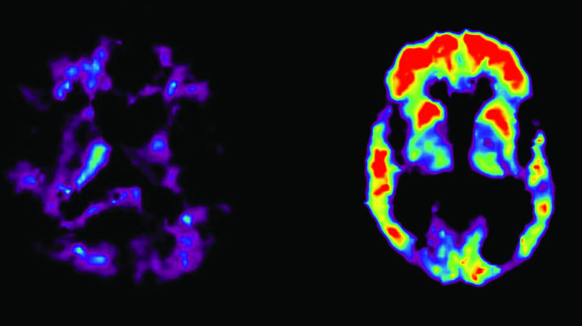 Memory Quizzes Still Best For Alzheimer's Diagnosis : Shots - Health ...