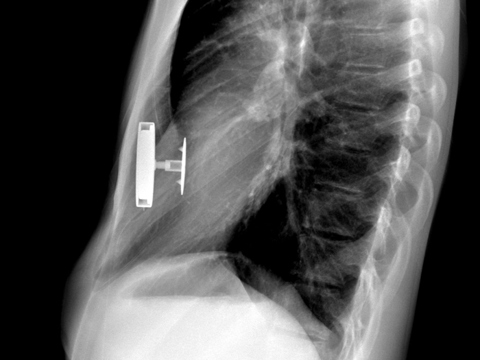 Magnets May Pull Kids With Sunken Chests Out Of Operating Room | NCPR News