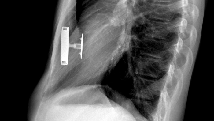 Magnets May Pull Kids With Sunken Chests Out Of Operating Room : Shots ...