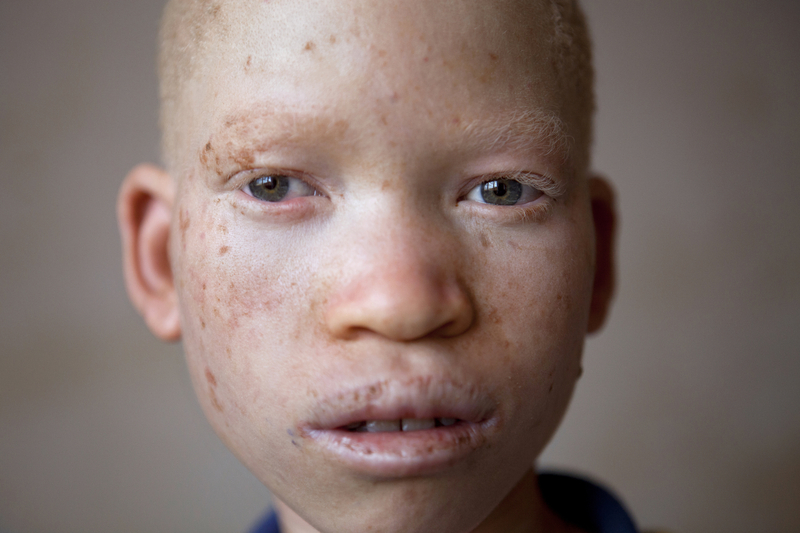 Portraits of Albinism: Letting An Inner Light Shine : The Picture Show ...