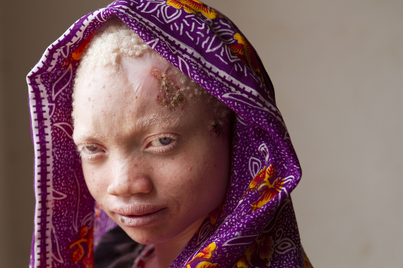 Portraits of Albinism: Letting An Inner Light Shine : The Picture Show ...