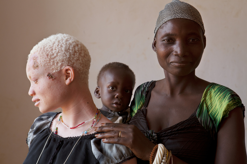 Portraits of Albinism: Letting An Inner Light Shine : The Picture Show ...