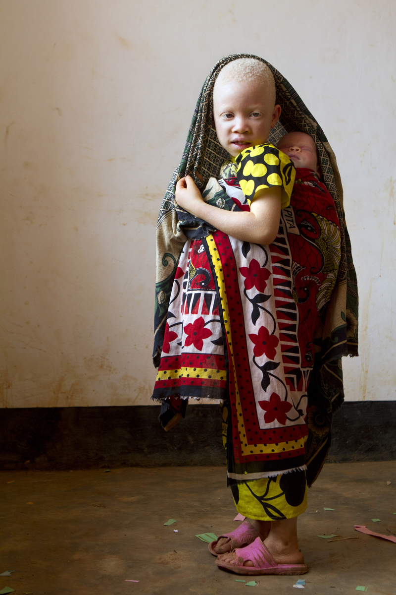 Portraits of Albinism: Letting An Inner Light Shine : The Picture Show ...