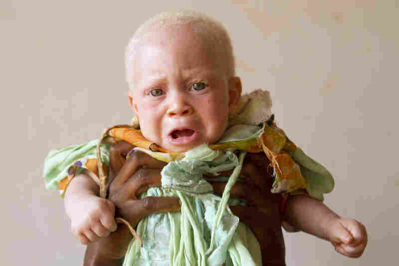 Portraits of Albinism: Letting An Inner Light Shine : The Picture Show ...