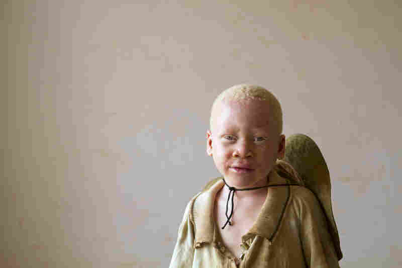Portraits of Albinism: Letting An Inner Light Shine : The Picture Show ...