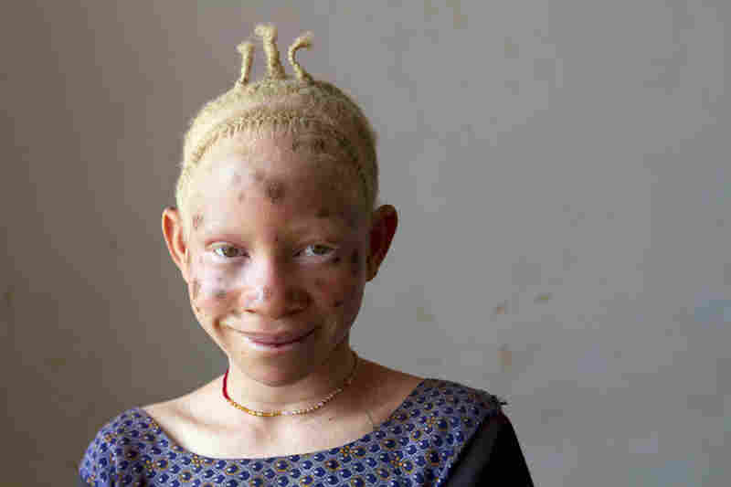 Portraits of Albinism: Letting An Inner Light Shine : The Picture Show ...