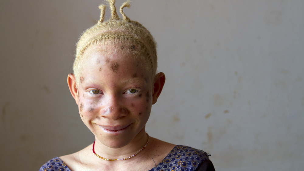 Portraits of Albinism: Letting An Inner Light Shine : The Picture Show ...