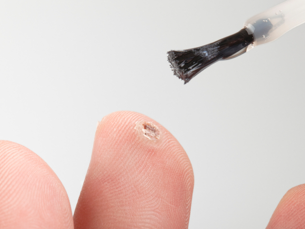 The Warts That Bind Your Family And Friends : Shots - Health News : NPR