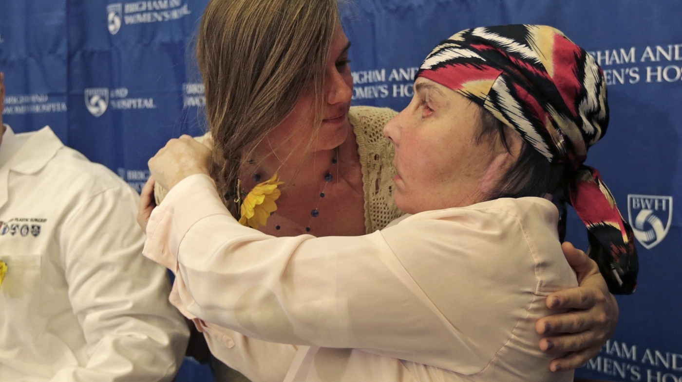 Falling In Love Again: Face-Transplant Donor's Daughter Meets Recipient ...