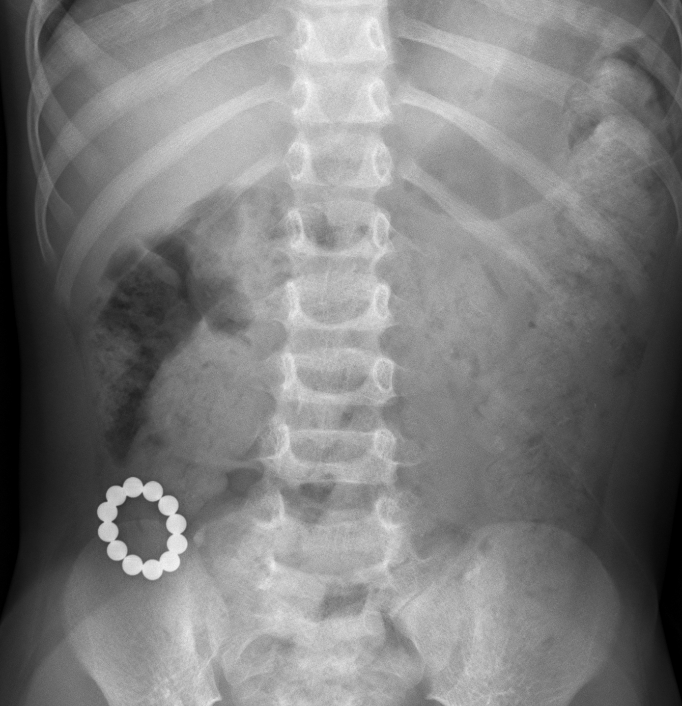 Swallowing Tiny Magnets Can Lead To Big Trouble For Kids : Shots ...