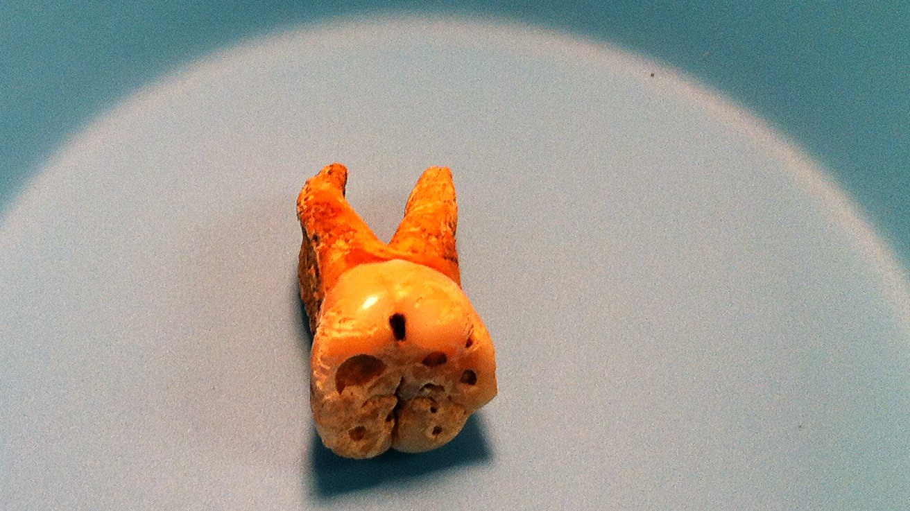 Ancient Plague's DNA Revived From A 1,500-Year-Old Tooth : Shots ...