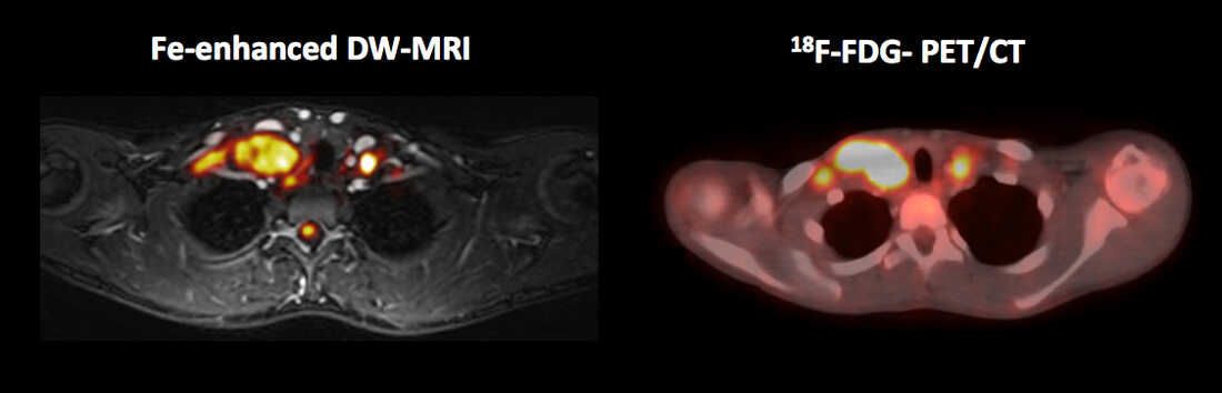 Tiny Iron Particles Help Find Cancer Without Using Risky Radiation ...