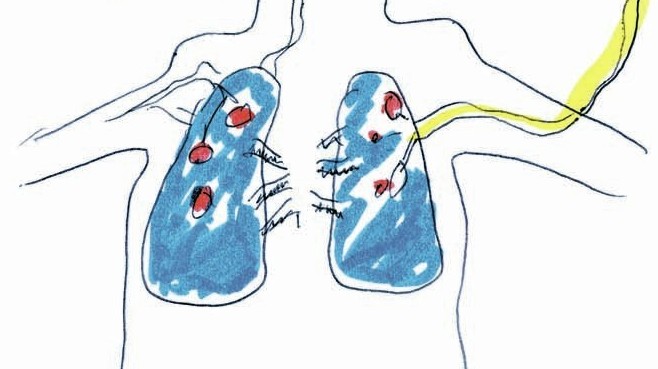 Drawing From The Experience Of 'Indolent But Relentless' Cancer : NPR