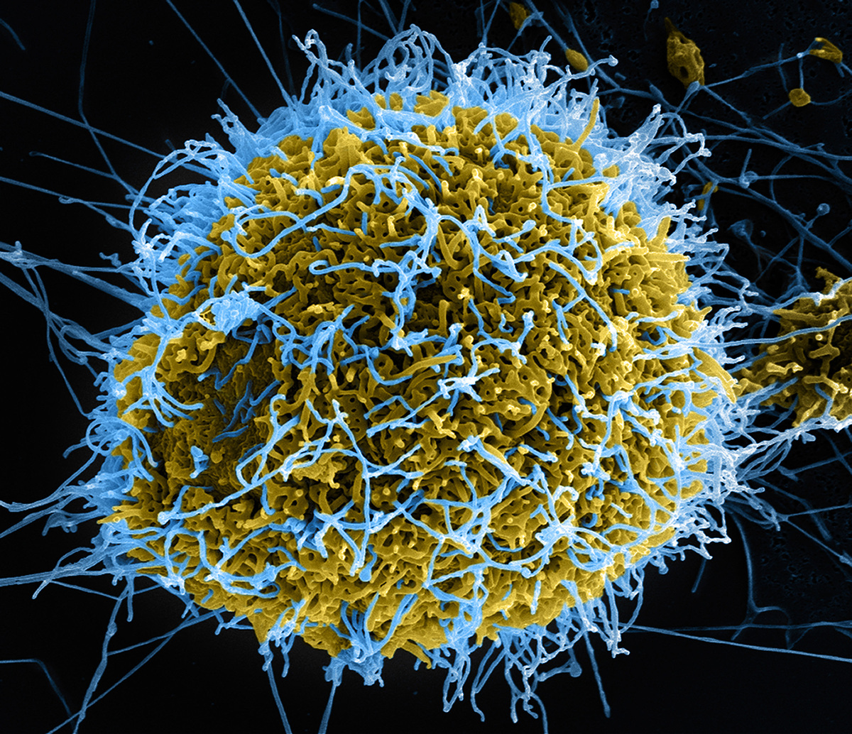 Mishandling Of Ebola Sample May Have Exposed CDC Technician To Virus ...