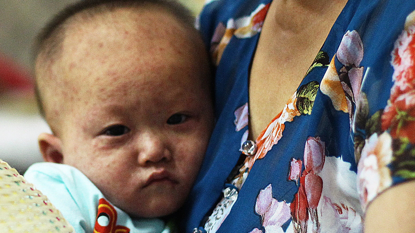 Measles Is A Killer: It Took 145,000 Lives Worldwide Last Year : Goats ...