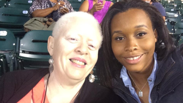 Hispanic Albino