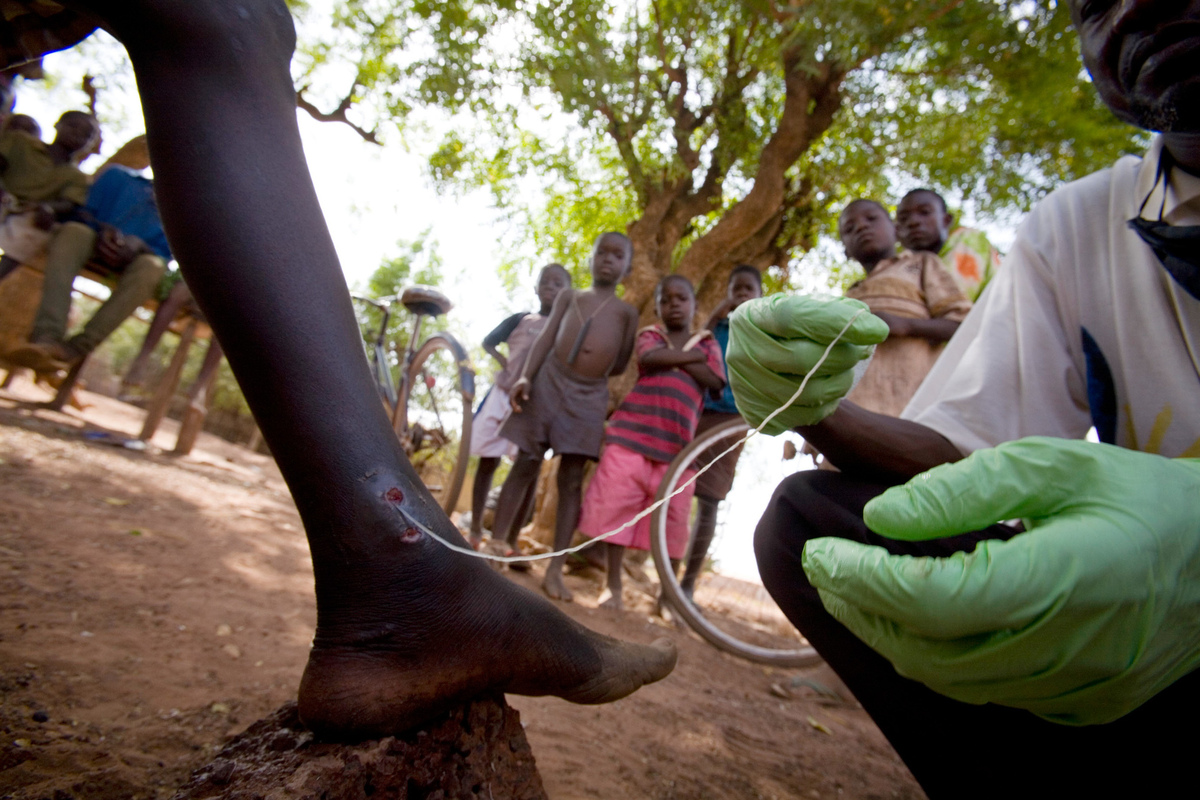 Guinea Worm Disease Could Soon Become The Second Human Disease To Be ...
