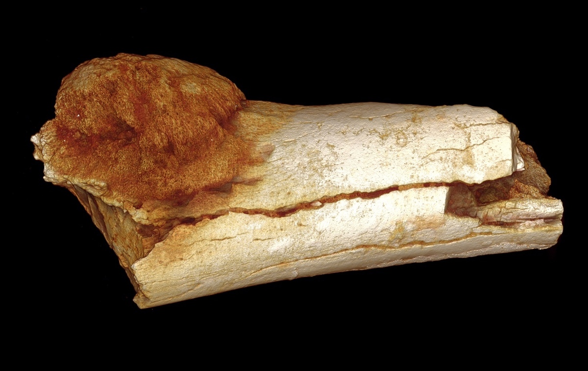 Ancient Bone Shows Evidence Of Cancer In Human Ancestor : The Two-Way : NPR