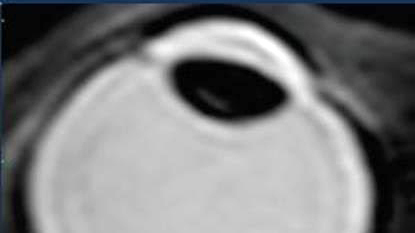 Science Explores Why Astronauts Eyes Change In Space : Shots - Health ...