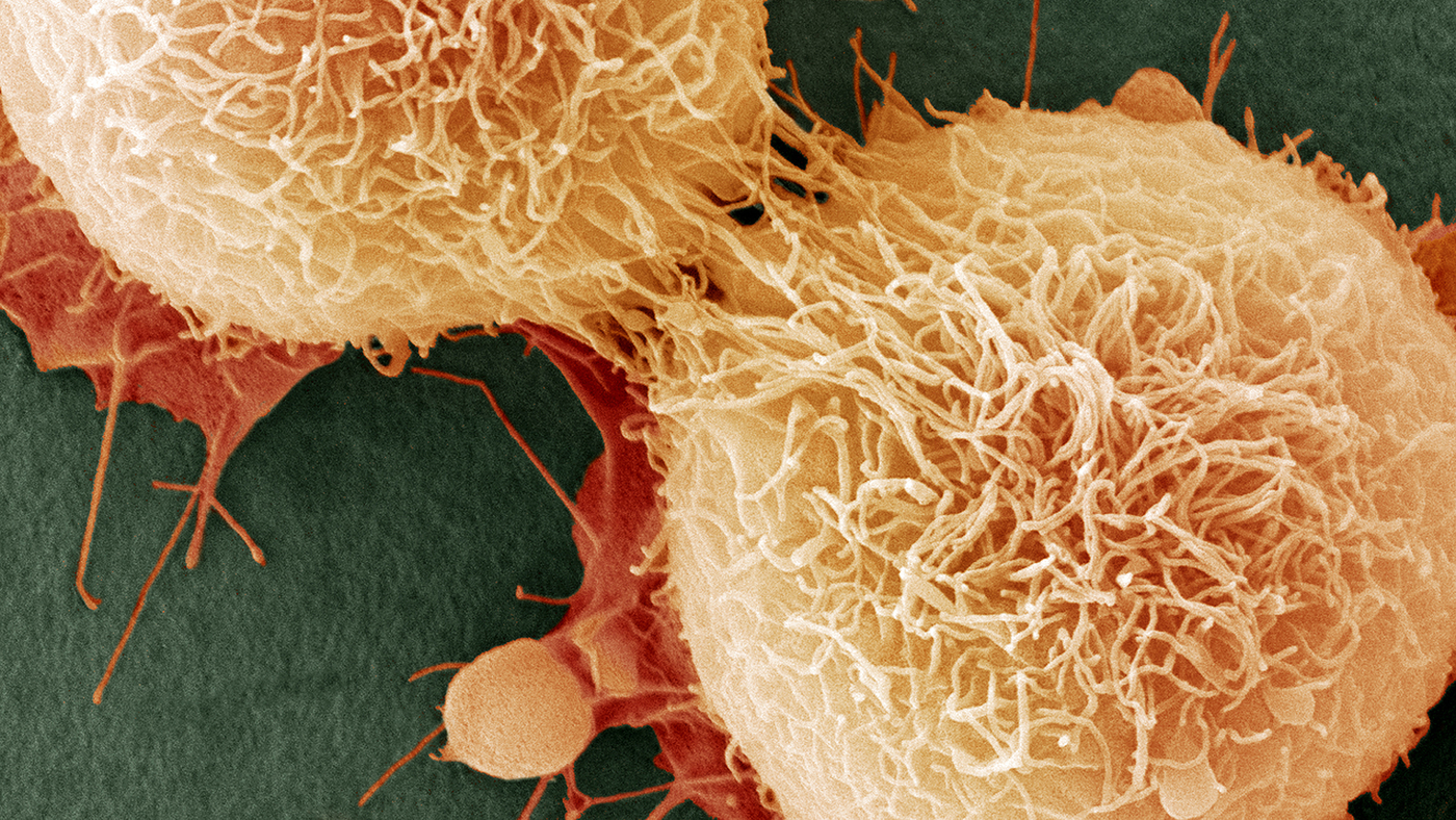 Cancer Is Partly Caused By Random Mutations, Study Finds : Shots ...