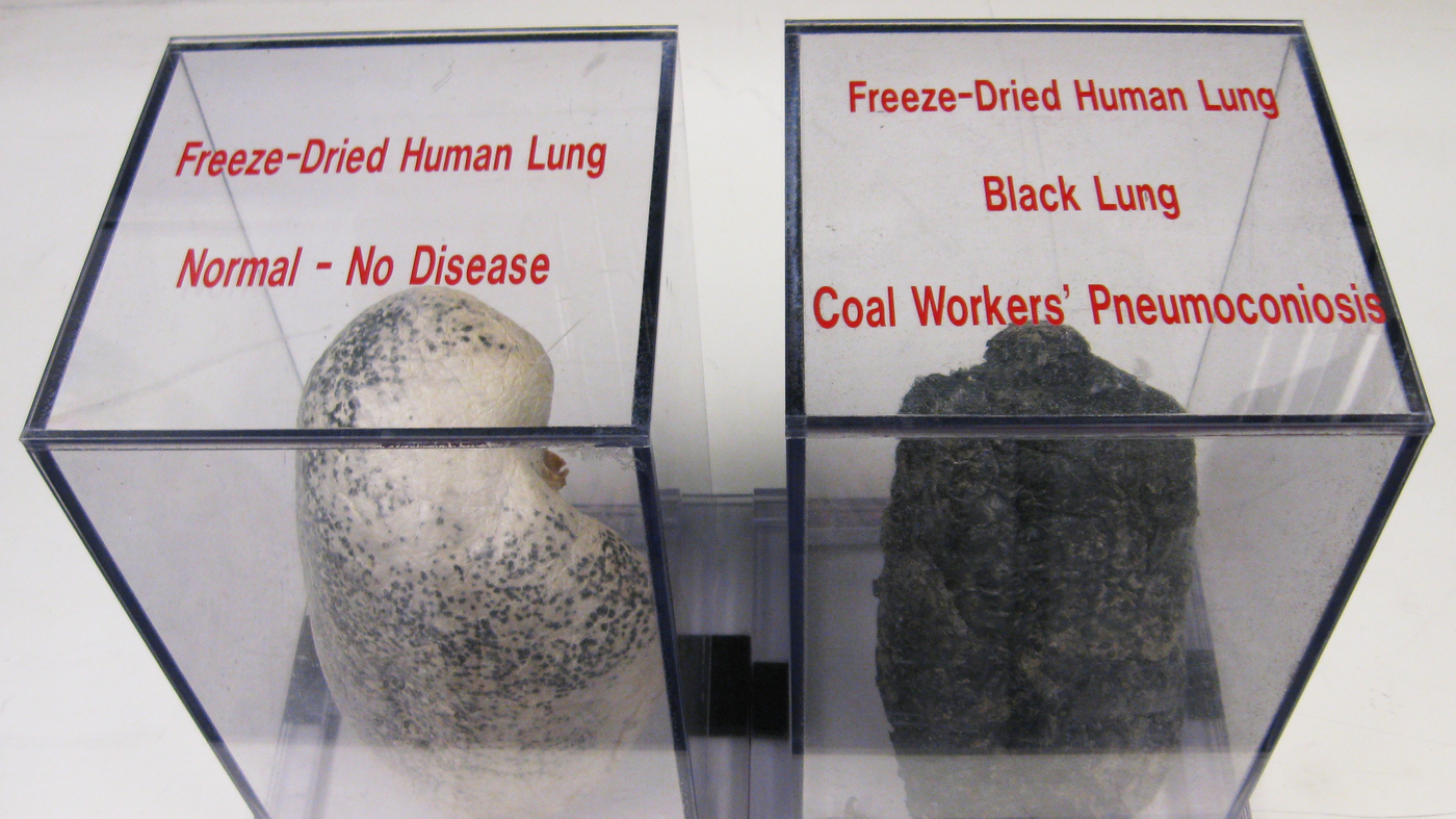 NPR Continues To Find Hundreds Of Cases Of Advanced Black Lung : The ...