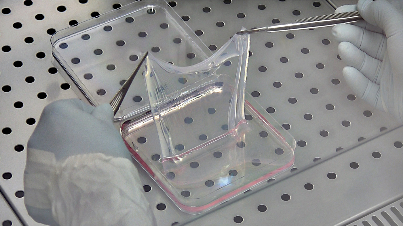 Genetically Altered Skin Saves A Boy Dying Of A Rare Disease : Shots ...