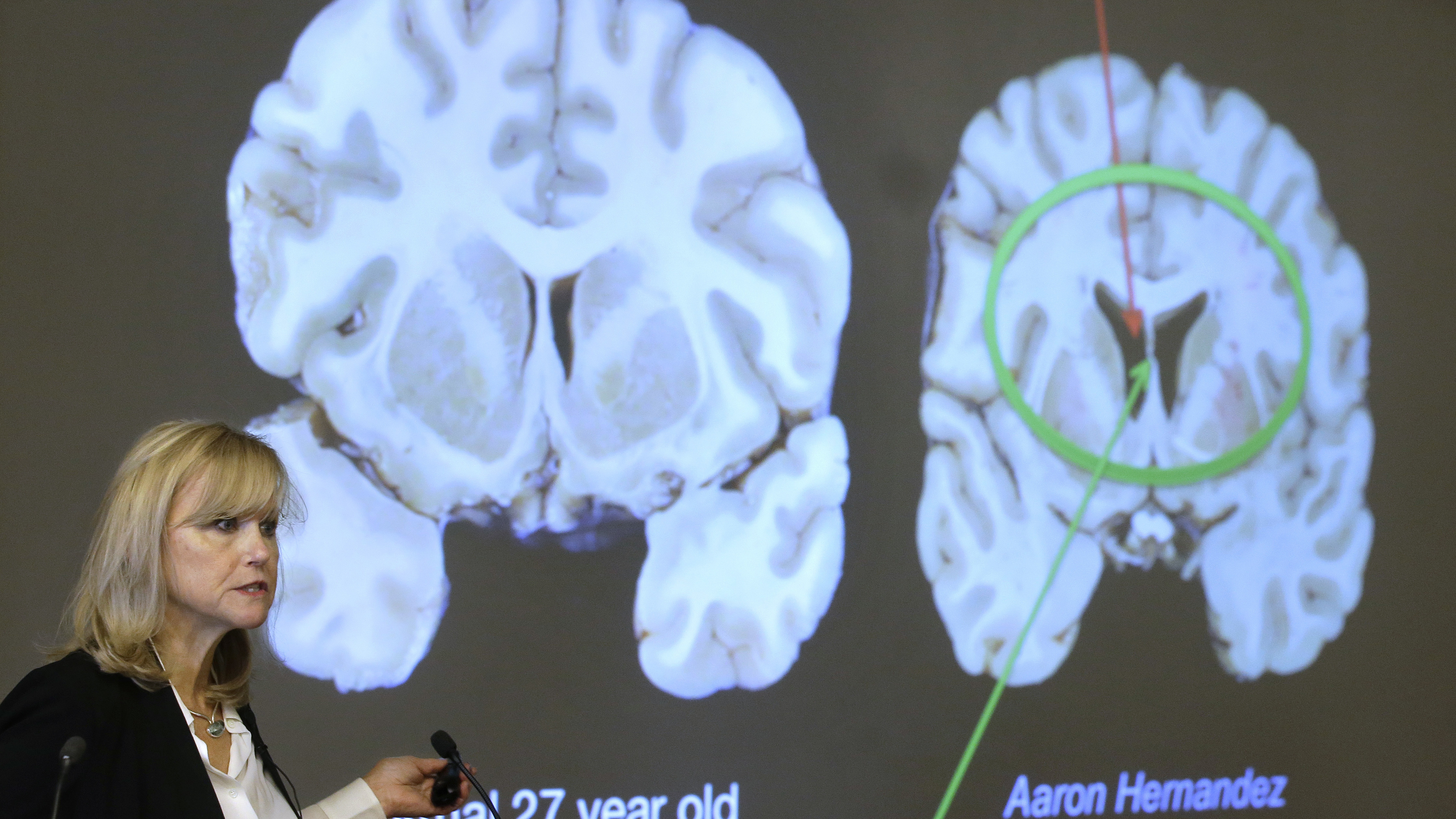 Researcher Says Aaron Hernandez's Brain Showed Signs Of Severe CTE ...