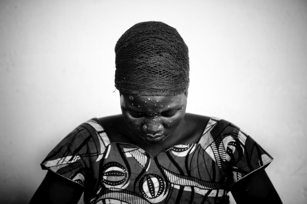 Monkeypox Outbreaks In Africa Are Making Headlines. How Worried Should ...