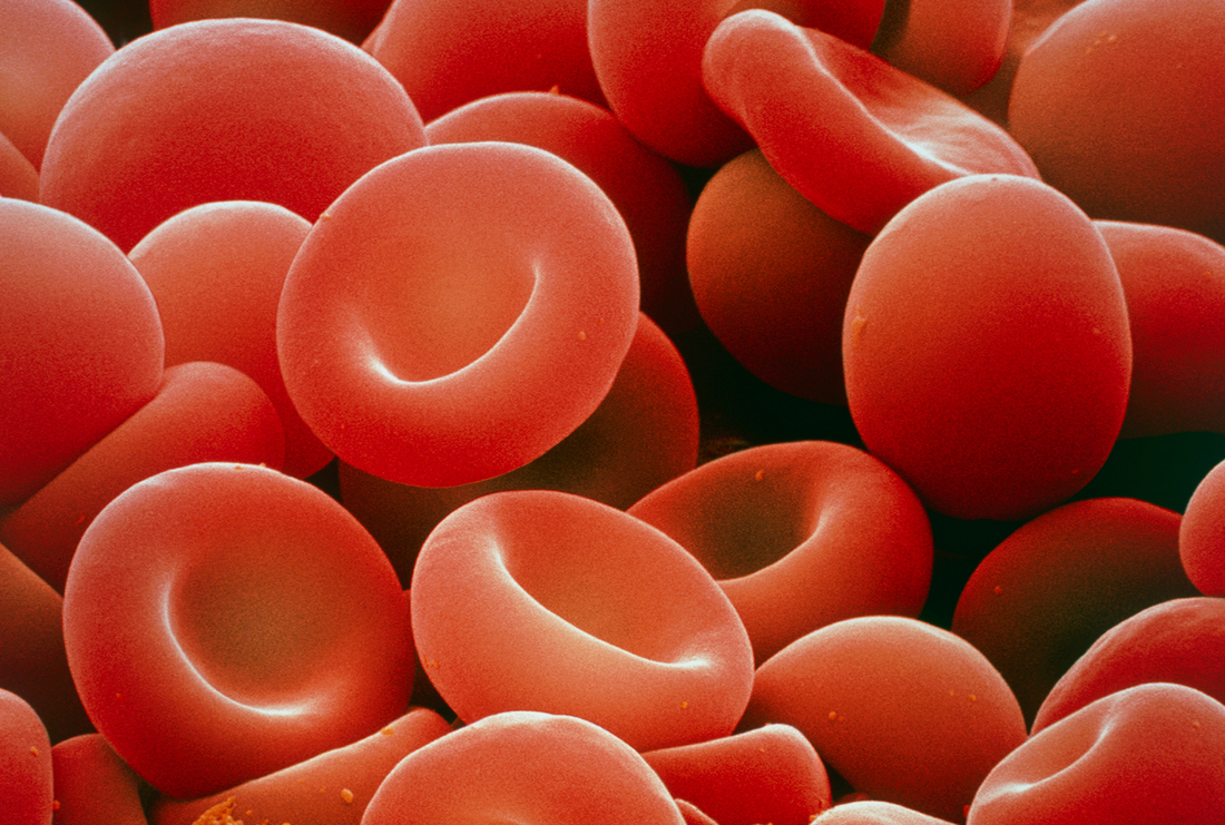 Beta-Thalassemia Treatment With Gene Therapy Reduced Transfusions ...