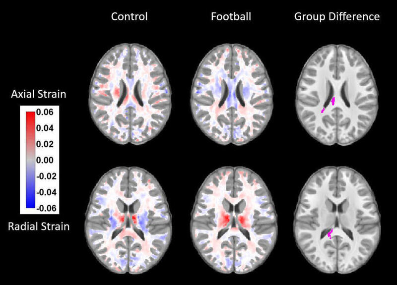 Brain Changes Seen After A Single Season Of Youth Football : Shots ...