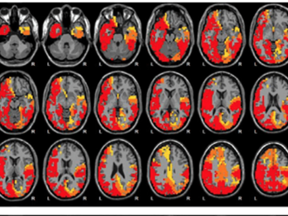 Addiction Clinics Market Unproven Infusion Treatments To Desperate ...