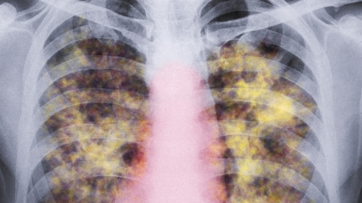 Lawmakers Seek Protections For Workers Against Lung Damage Tied To ...