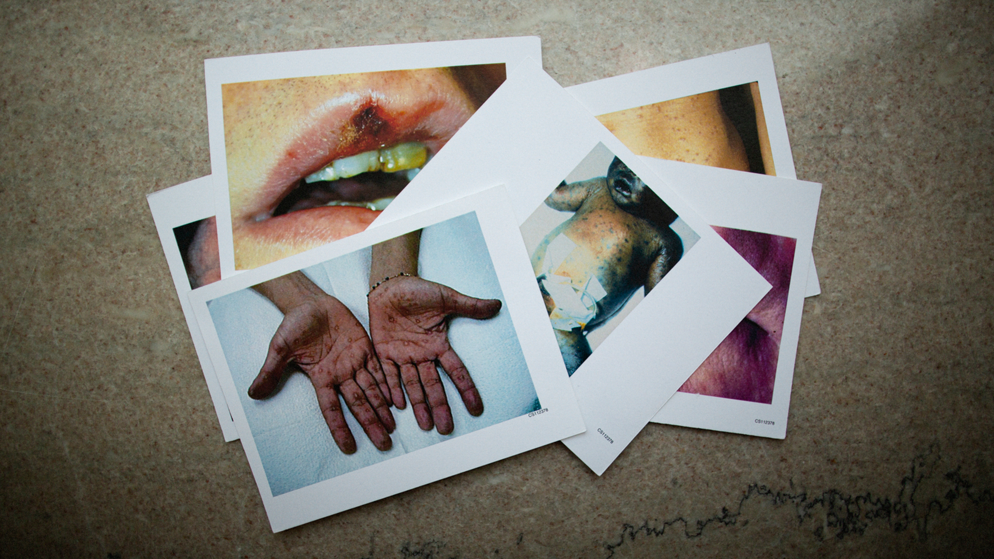 Syphilis is resurging in the U.S., a sign of public health's funding ...