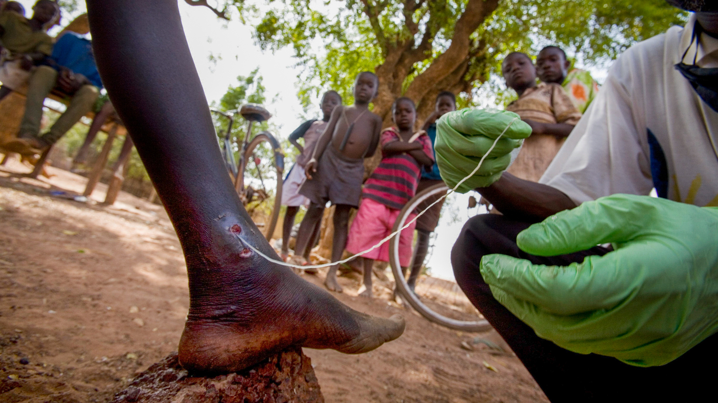 Jimmy Carter took on Guinea worm disease — and had remarkable success ...