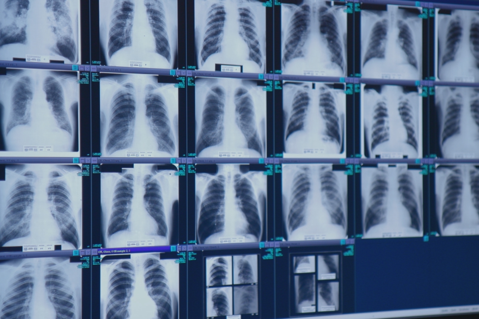 As coal miners suffer and die from severe black lung, a proposed fix ...