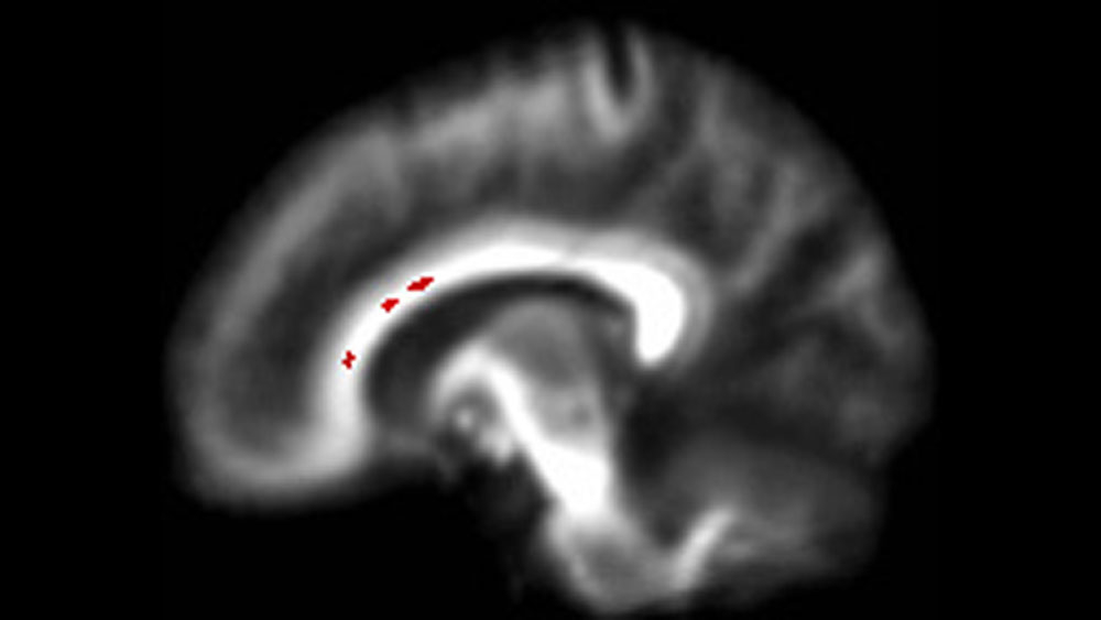 Teen Drinking May Cause Irreversible Brain Damage : NPR