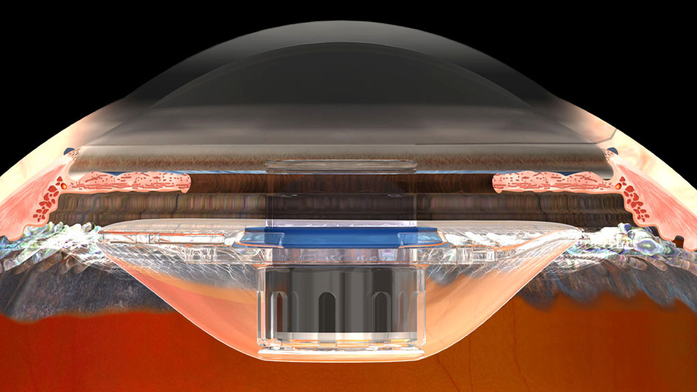 Tiny Eye Telescope Brings Back A World Of Sight : NPR