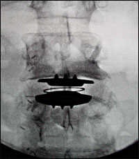 Artificial Disc Offers New Hope for Treating Back Pain : NPR