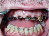'Meth Mouth' Strains Prison Health-Care Budgets : NPR