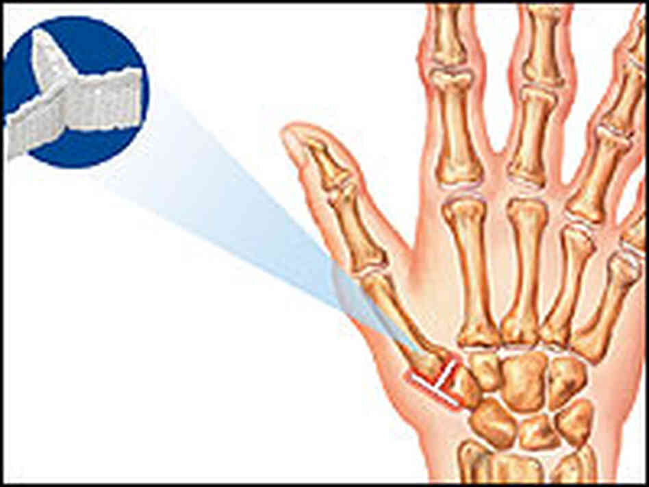 Get Rid of Your Arthritis with Artelon Thumb Implant Product ...